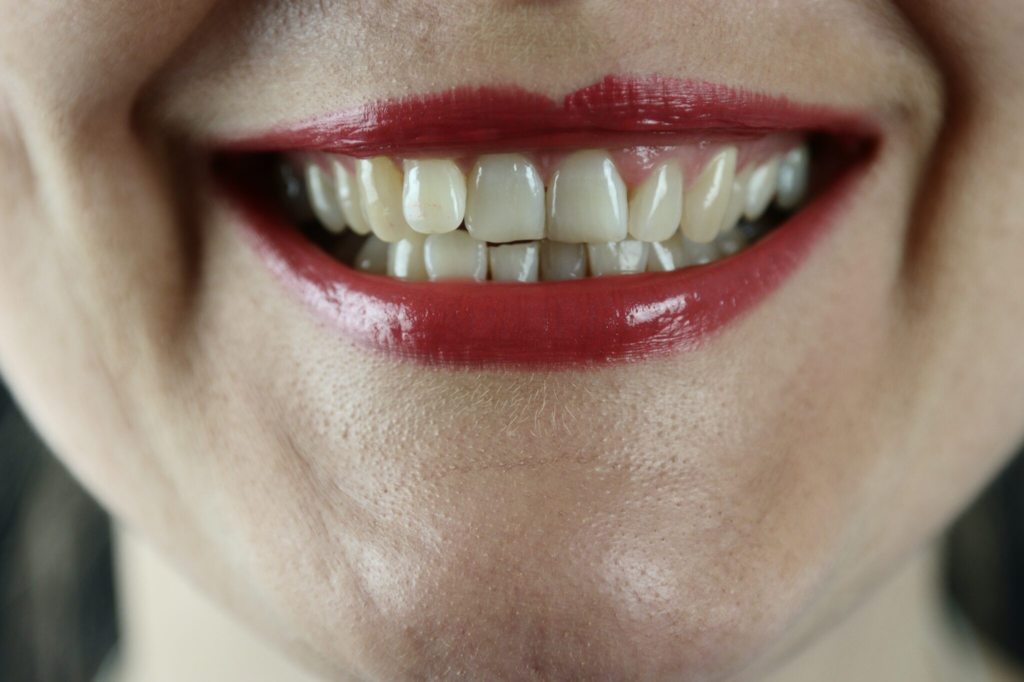 Mondslijmvliesontsteking: 5 tips bij ontstekingen in je mondholte…